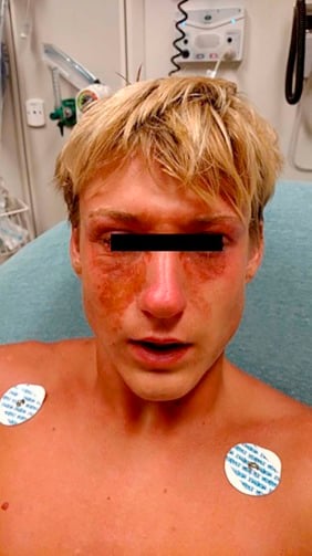 The Risk of Commercial Swimming Pool Chemical Burns