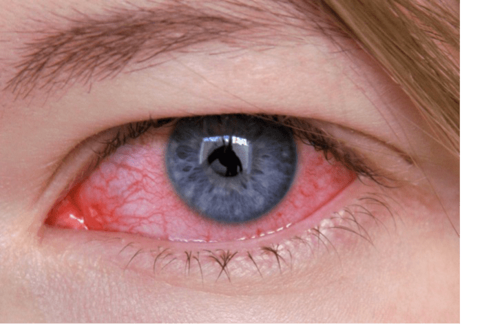 Swimmer's Eye